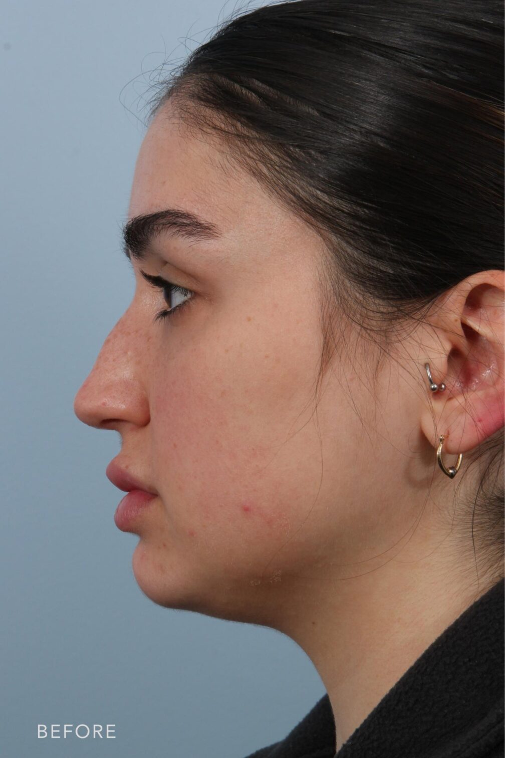 Rhinoplasty & Nasal Reconstruction Pictures | Williams Center Williams ...