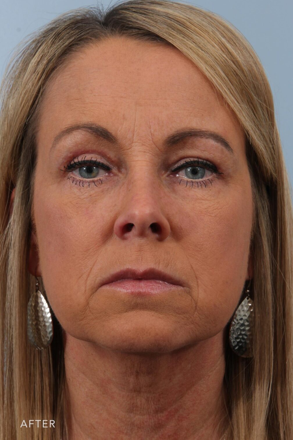 Blepharoplasty Pictures - Eyelid Surgery | Williams Center Williams Center