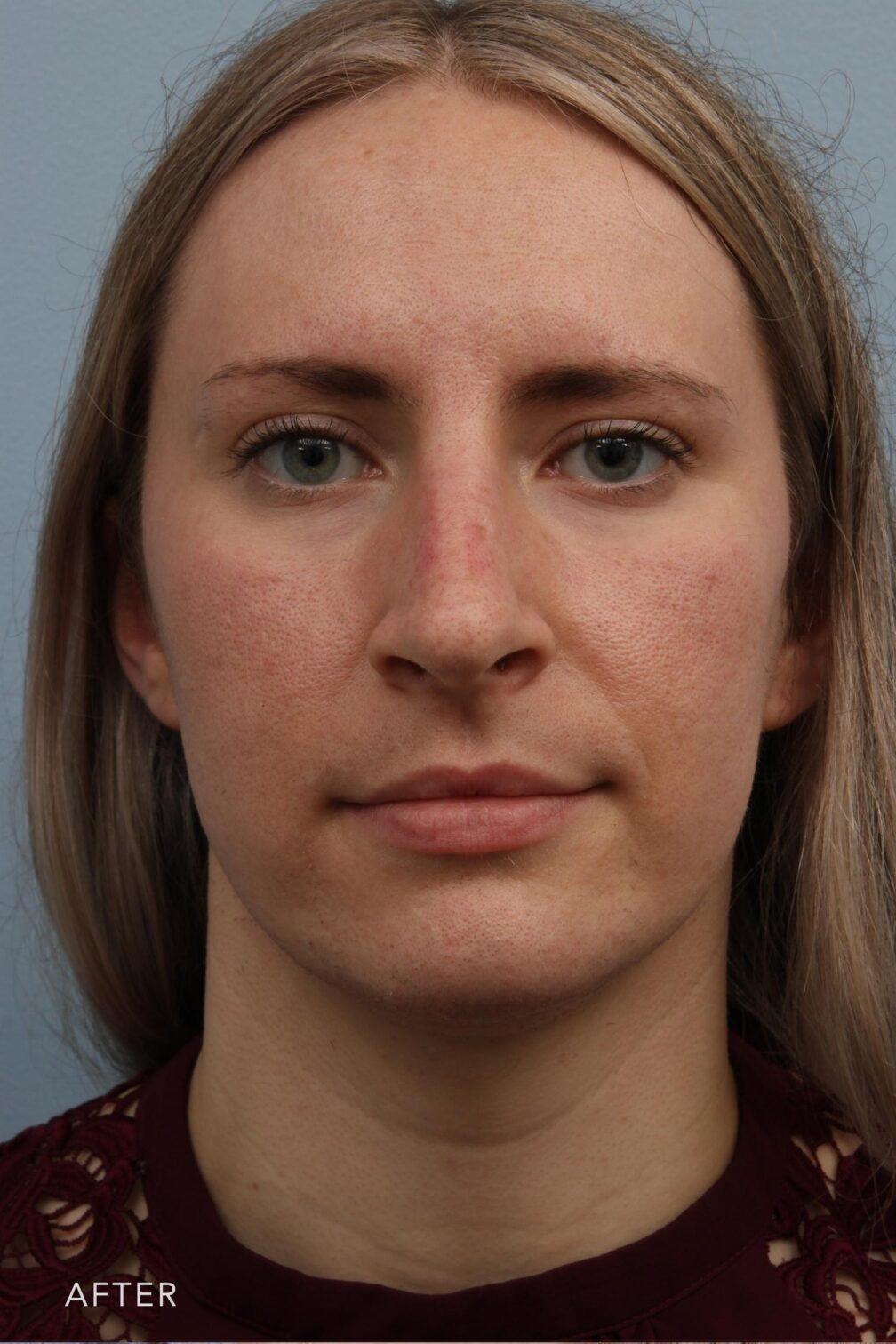 Rhinoplasty & Nasal Reconstruction Pictures | Williams Center Williams ...