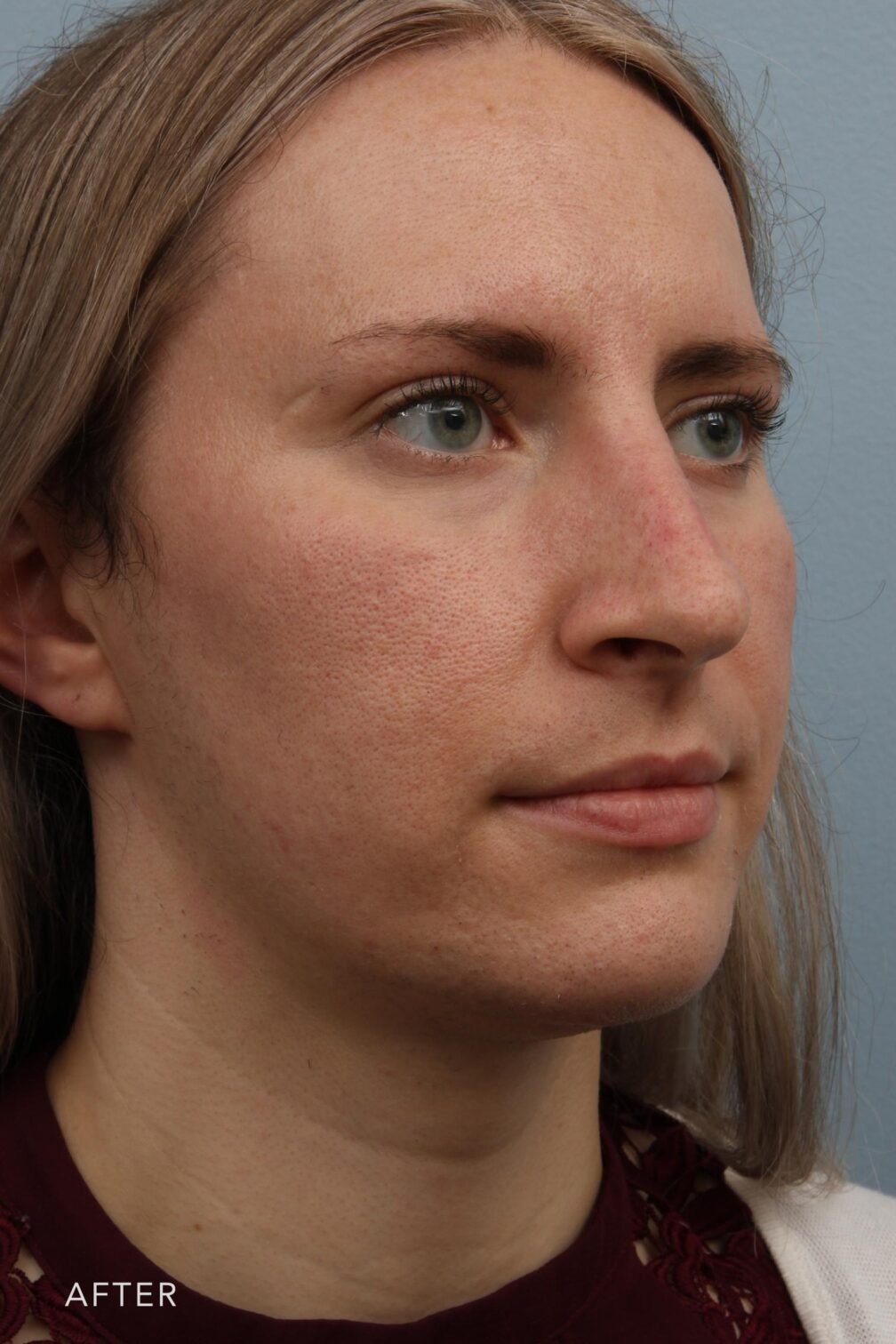 Rhinoplasty & Nasal Reconstruction Pictures | Williams Center Williams ...