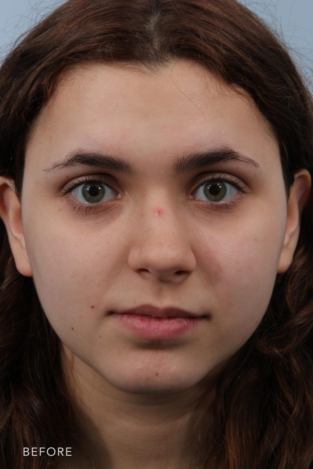 Rhinoplasty & Nasal Reconstruction Pictures | Williams Center Williams ...