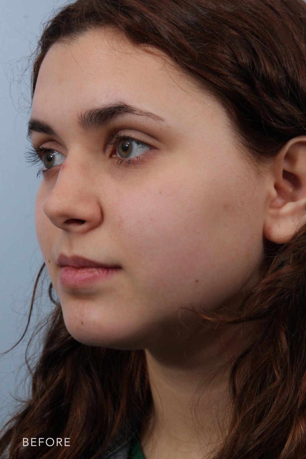 Rhinoplasty & Nasal Reconstruction Pictures | Williams Center Williams ...