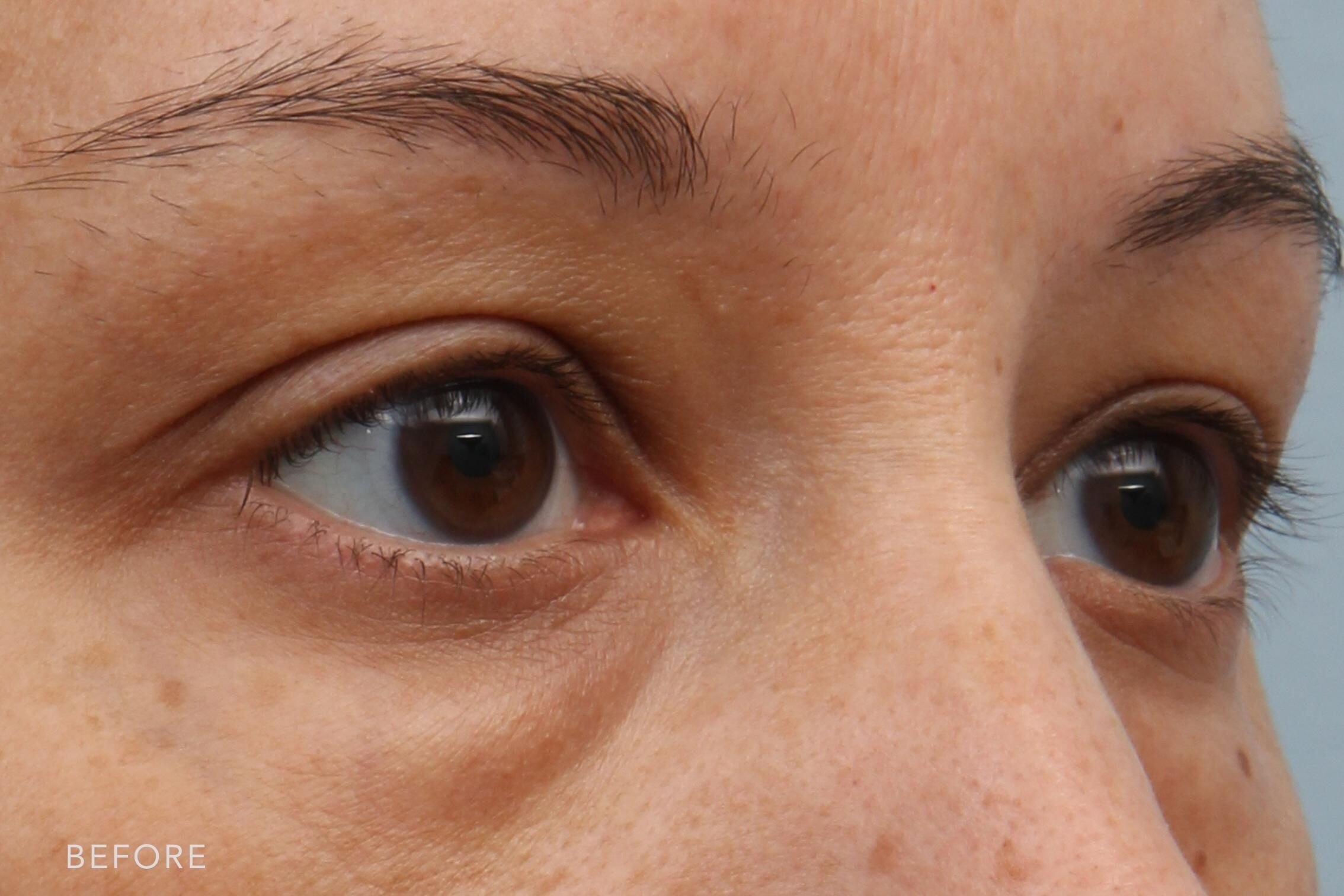 Blepharoplasty Pictures - Eyelid Surgery | Williams Center Williams Center