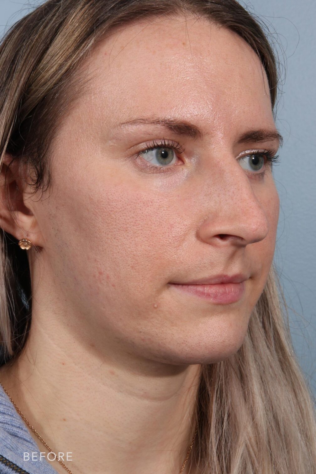 Rhinoplasty & Nasal Reconstruction Pictures | Williams Center Williams ...