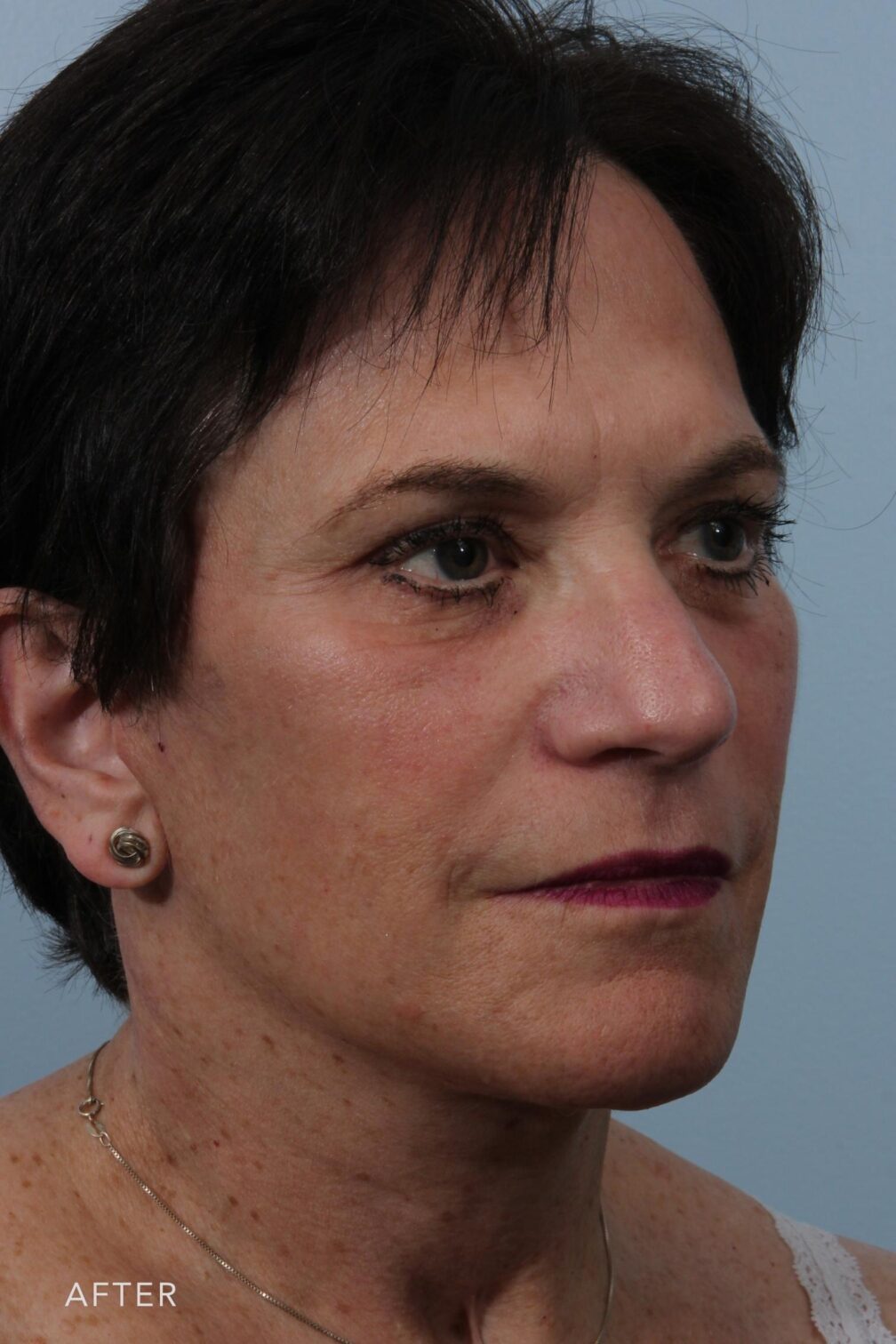 Rhinoplasty & Nasal Reconstruction Pictures | Williams Center Williams ...