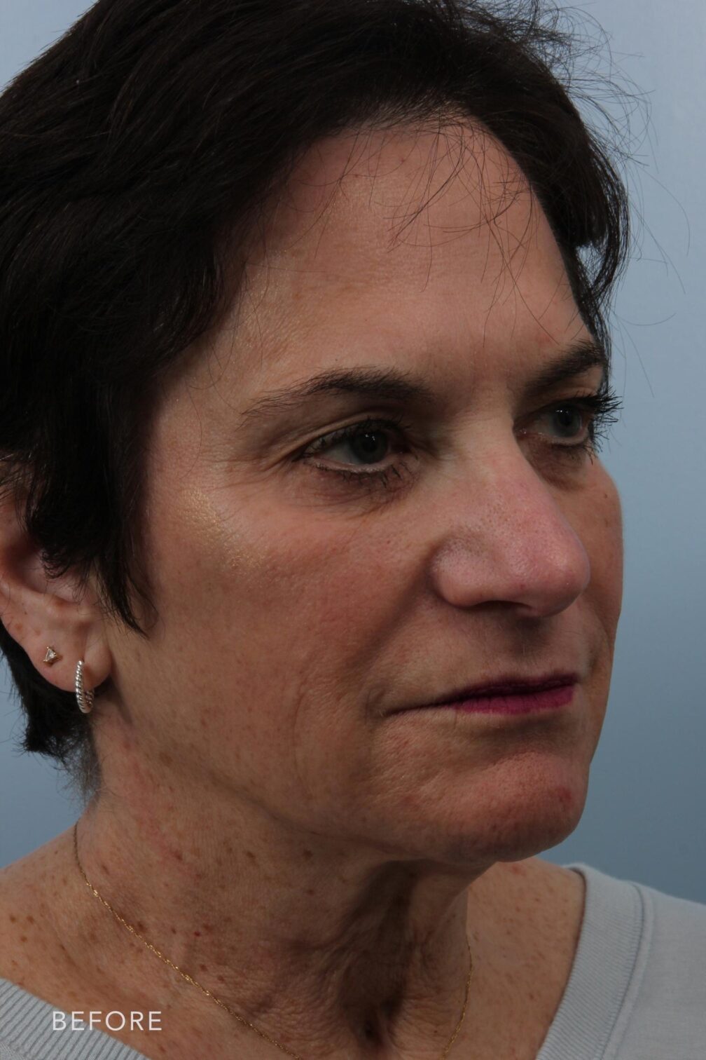 Rhinoplasty & Nasal Reconstruction Pictures | Williams Center Williams ...