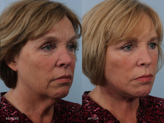 FL109 | Deep Plane Facelift Albany, Latham, Saratoga NY - Williams ...