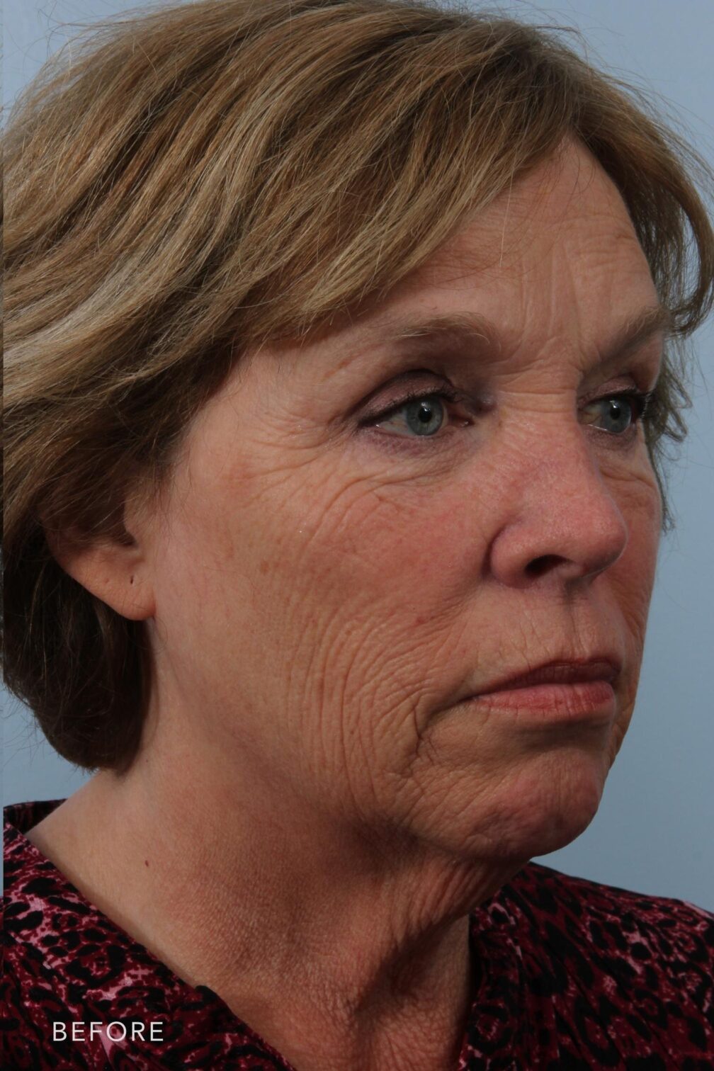 Deep Plane Facelift Before & After Gallery | The Williams Center ...