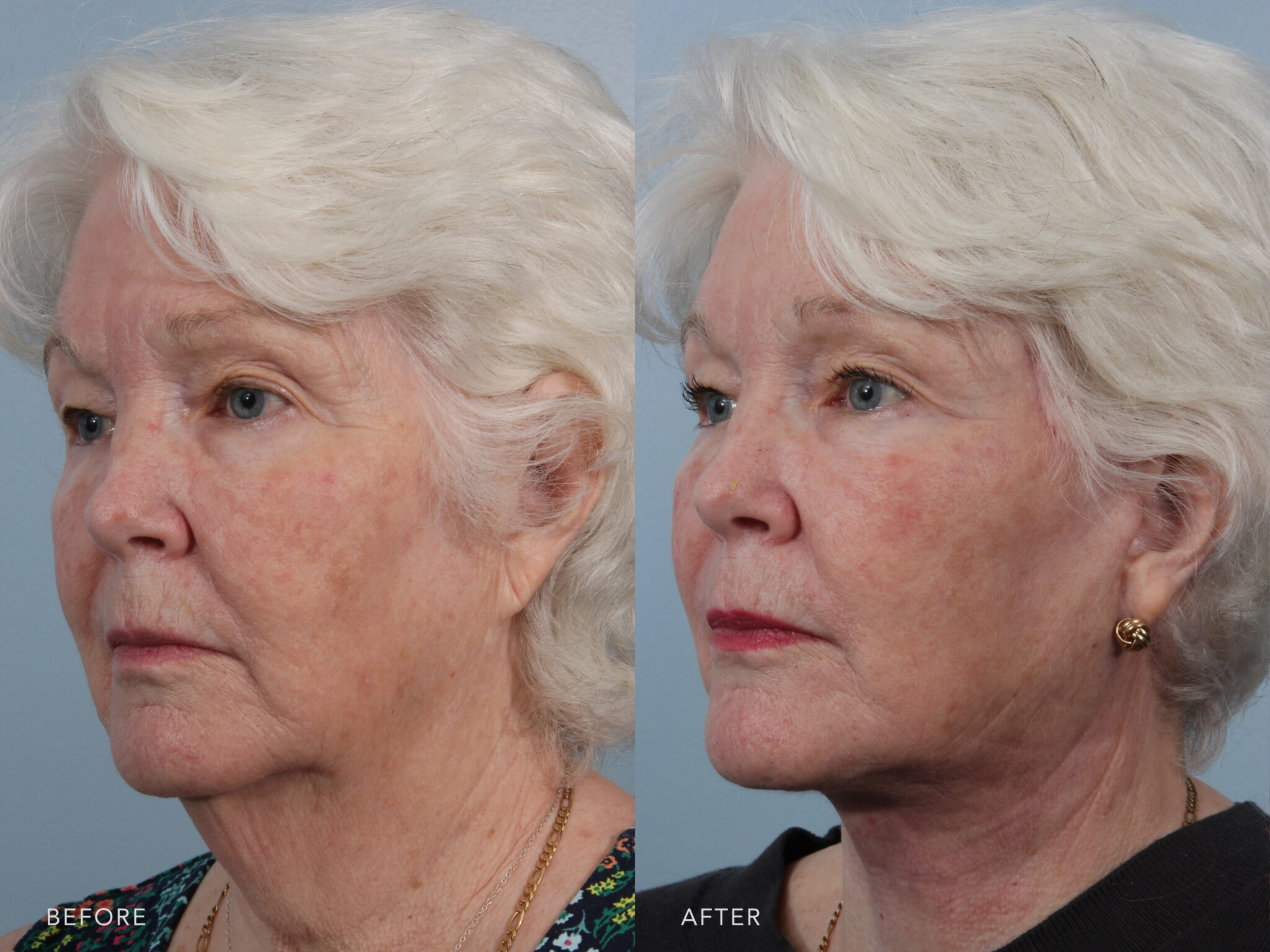 Deep Plane Facelift Cost Breakdown [2025] | Williams Center Williams Center