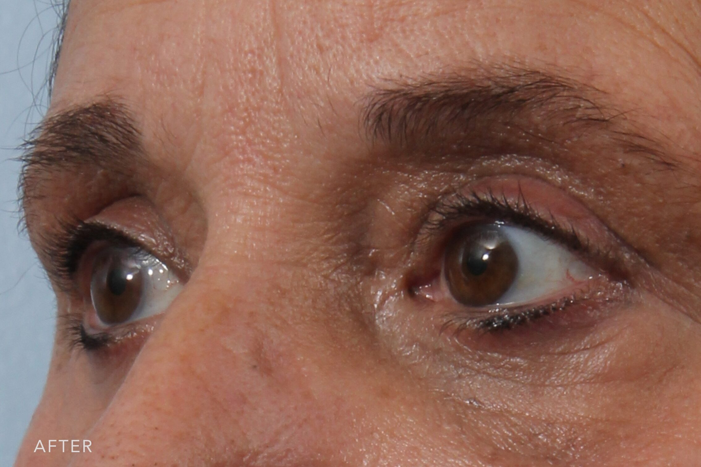 Blepharoplasty Pictures - Eyelid Surgery | Williams Center Williams Center