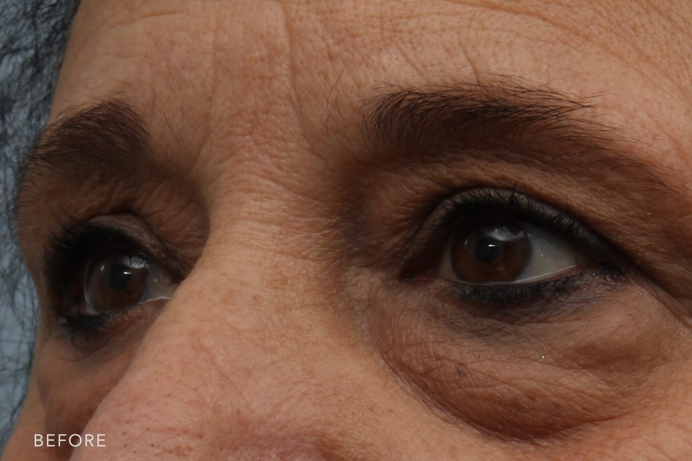 Blepharoplasty Pictures - Eyelid Surgery | Williams Center Williams Center
