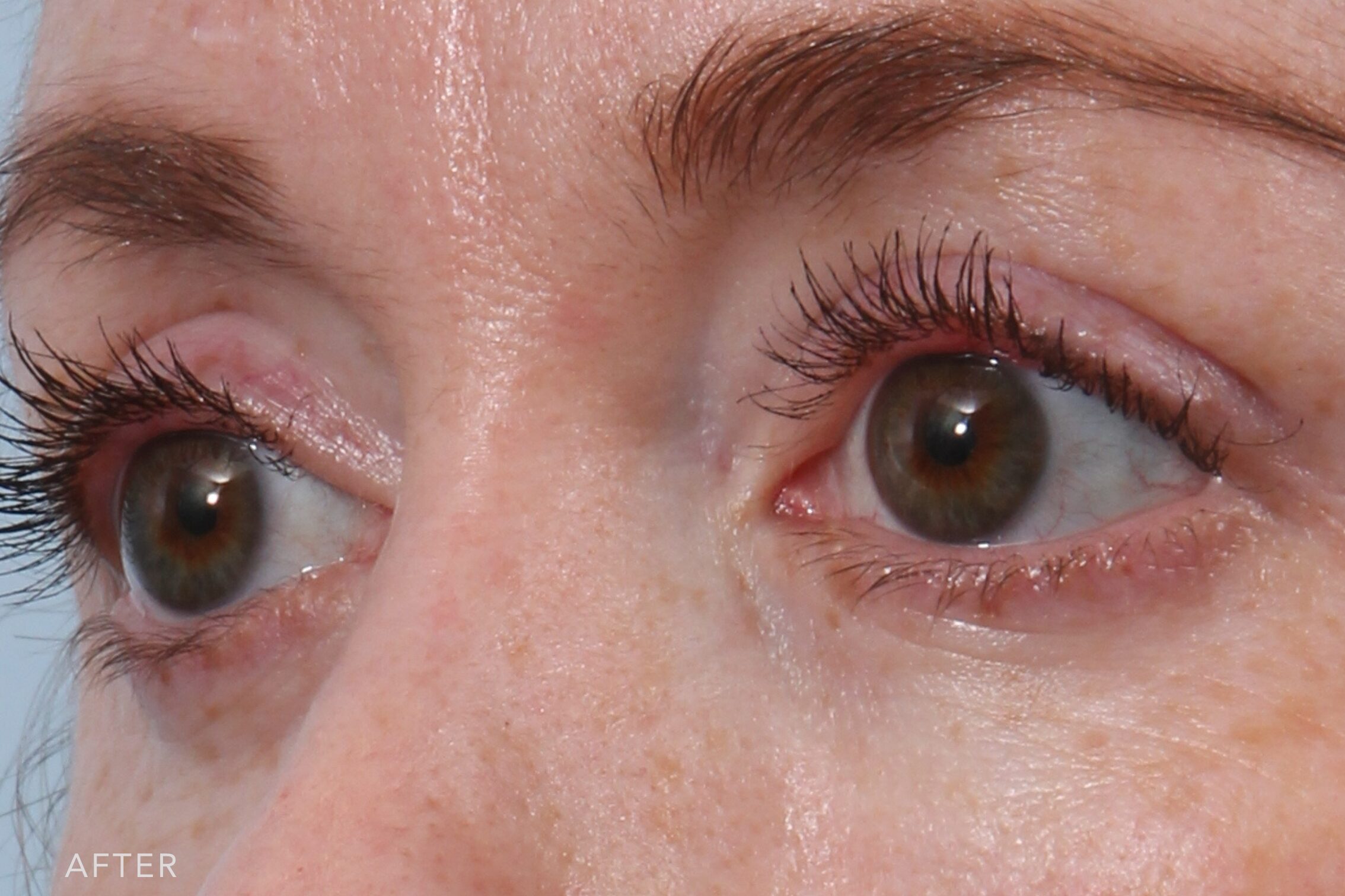 Blepharoplasty Pictures - Eyelid Surgery | Williams Center Williams Center