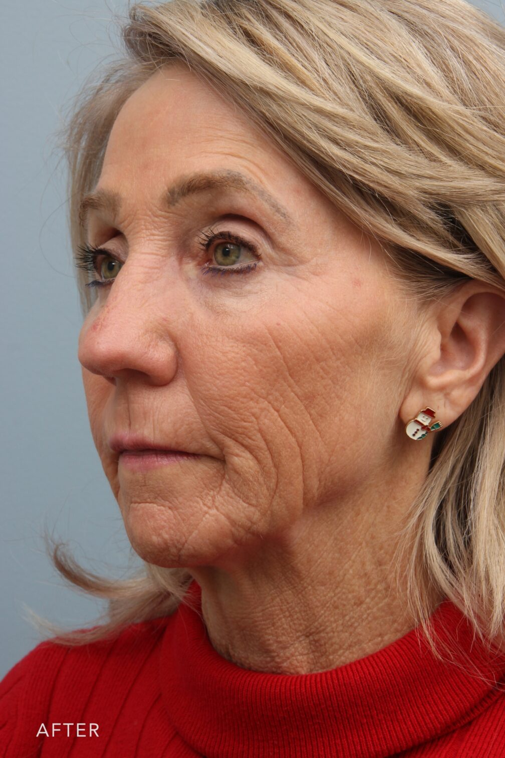 Blepharoplasty Pictures - Eyelid Surgery | Williams Center Williams Center