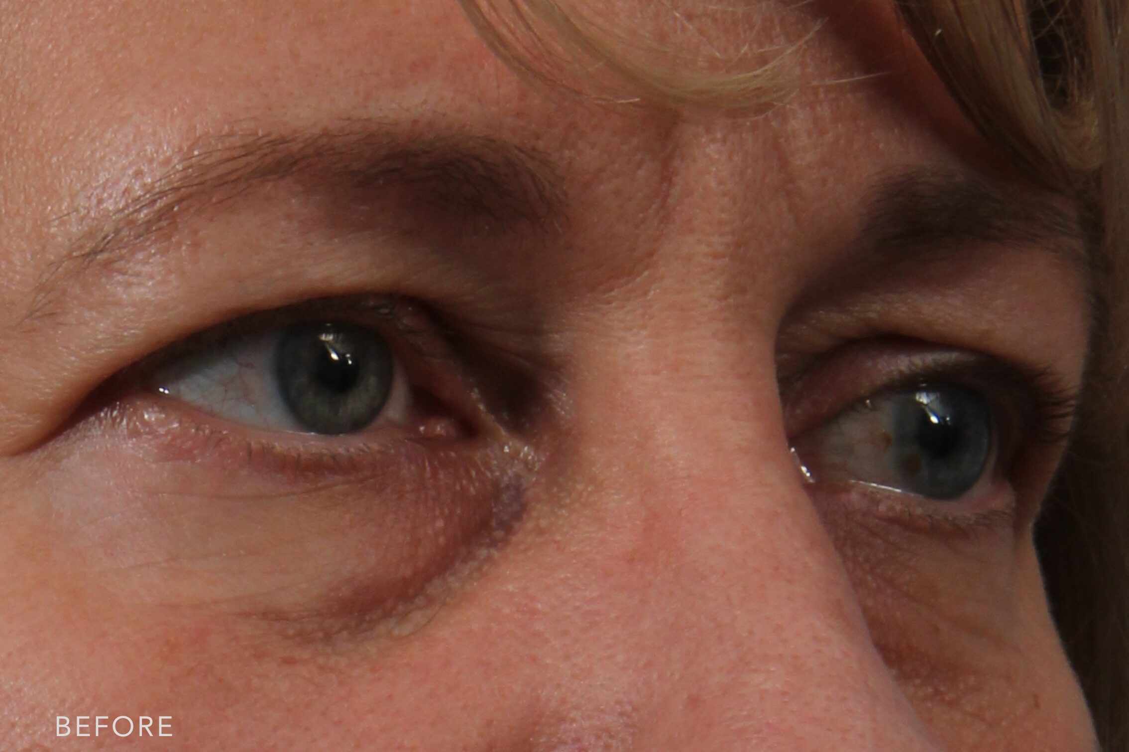 Blepharoplasty Pictures - Eyelid Surgery | Williams Center Williams Center