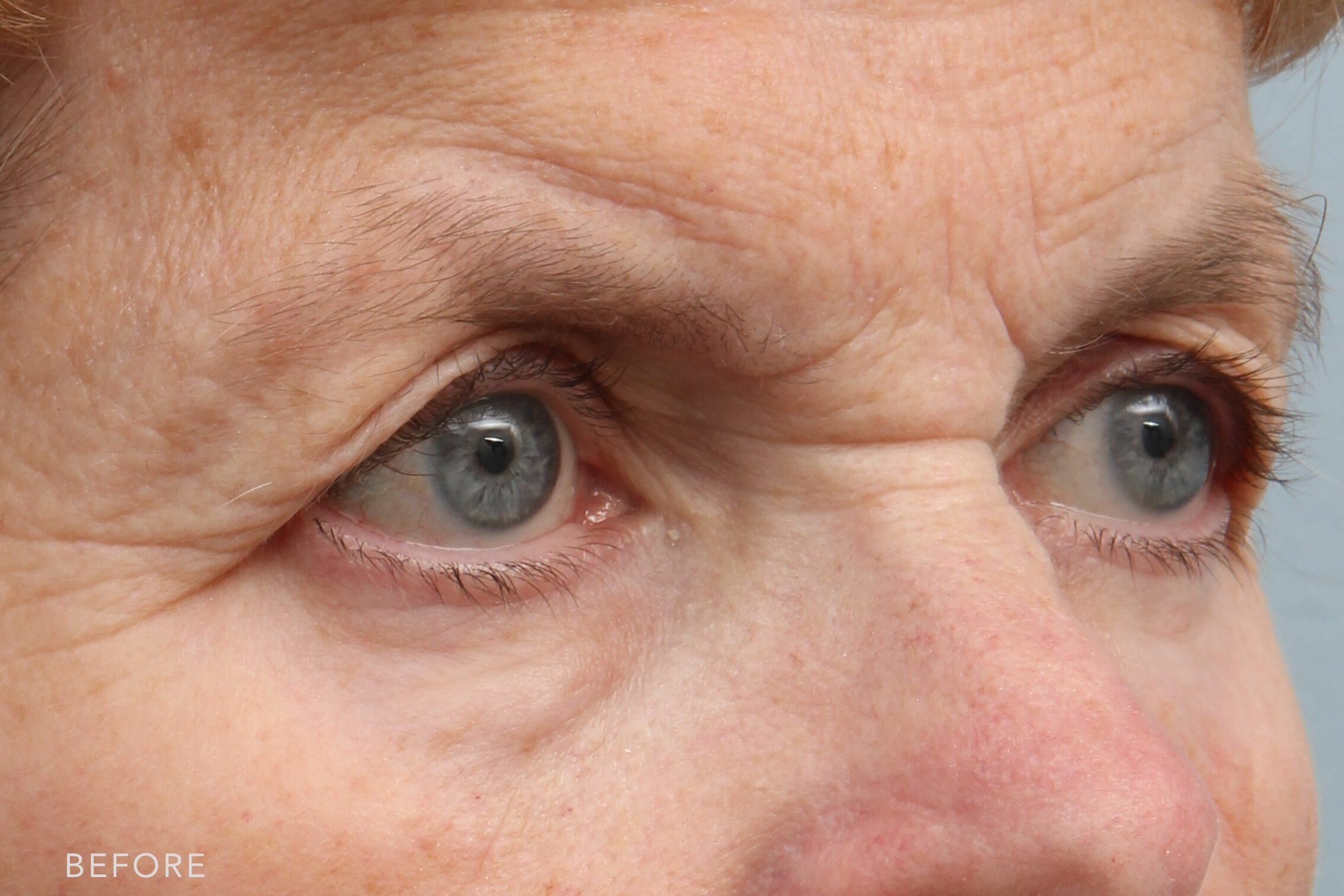 Blepharoplasty Pictures - Eyelid Surgery | Williams Center Williams Center