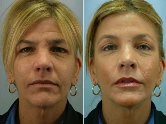 Browlift vs. Botox: What’s the Difference?| Williams Center Williams Center