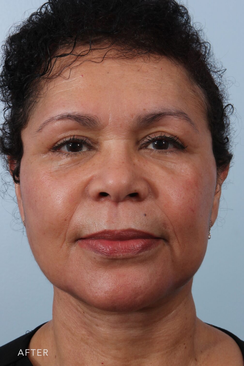 Facial Procedures Archives - Williams Center Williams Center