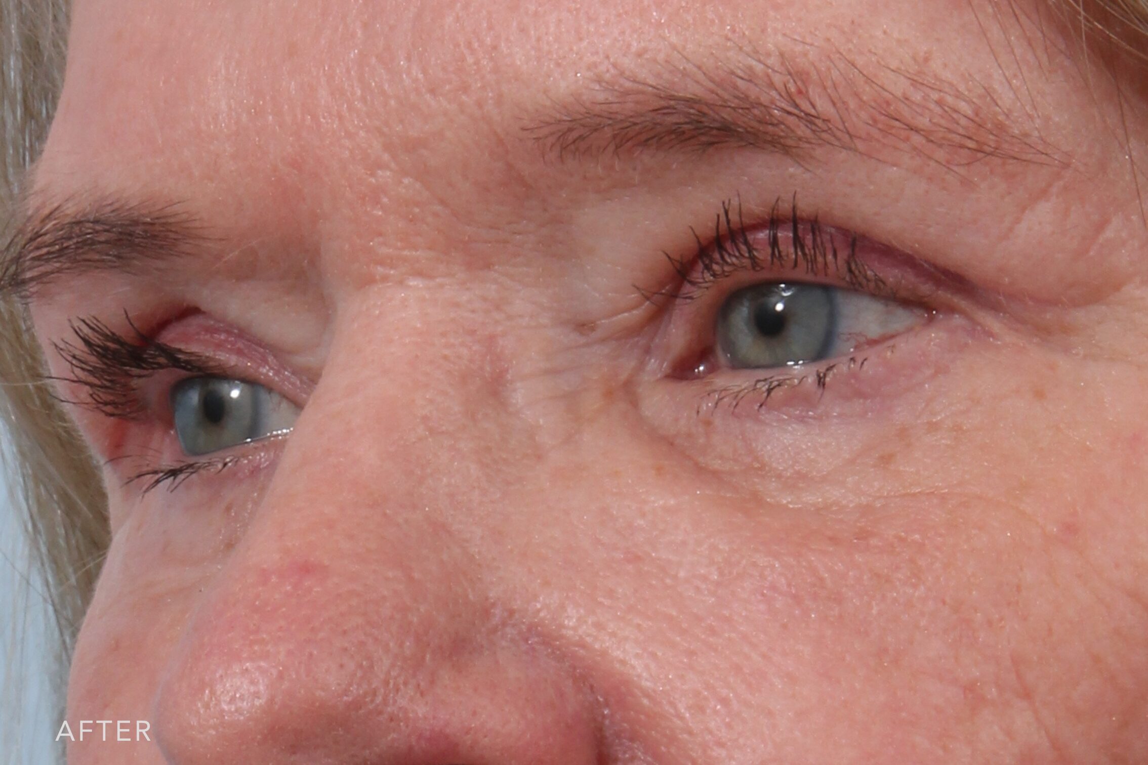 Blepharoplasty Pictures - Eyelid Surgery | Williams Center Williams Center