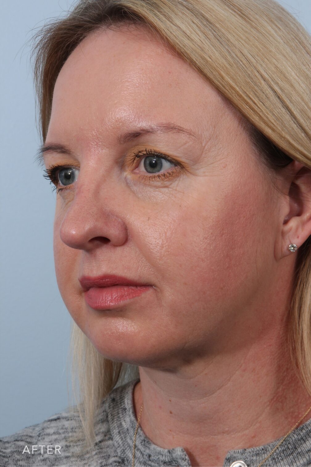 Rhinoplasty & Nasal Reconstruction Pictures | Williams Center Williams ...