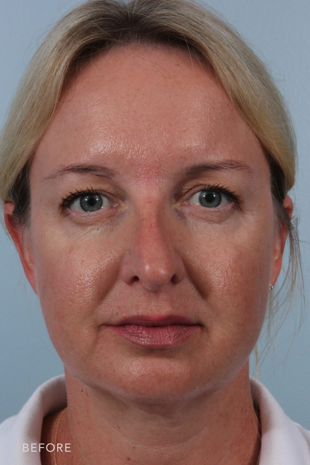 Rhinoplasty & Nasal Reconstruction Pictures | Williams Center Williams ...