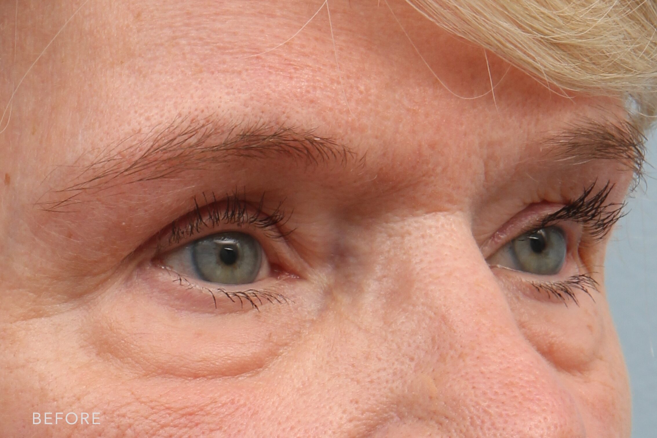 Blepharoplasty Pictures - Eyelid Surgery | Williams Center Williams Center
