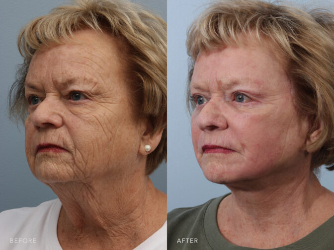 FL125 | Deep Plane Facelift Surgery Albany, Latham, Saratoga NY ...