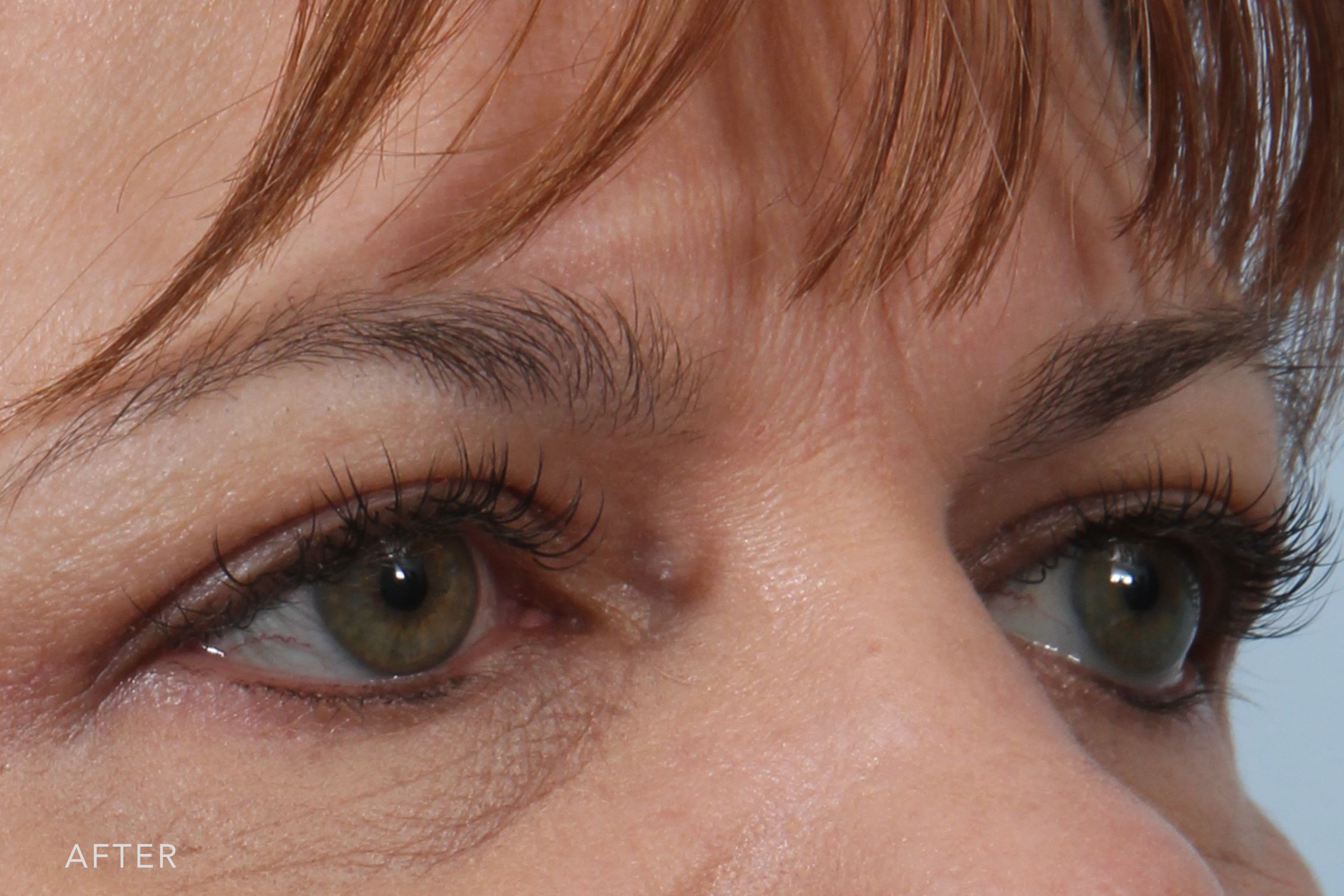 Blepharoplasty Pictures - Eyelid Surgery | Williams Center Williams Center