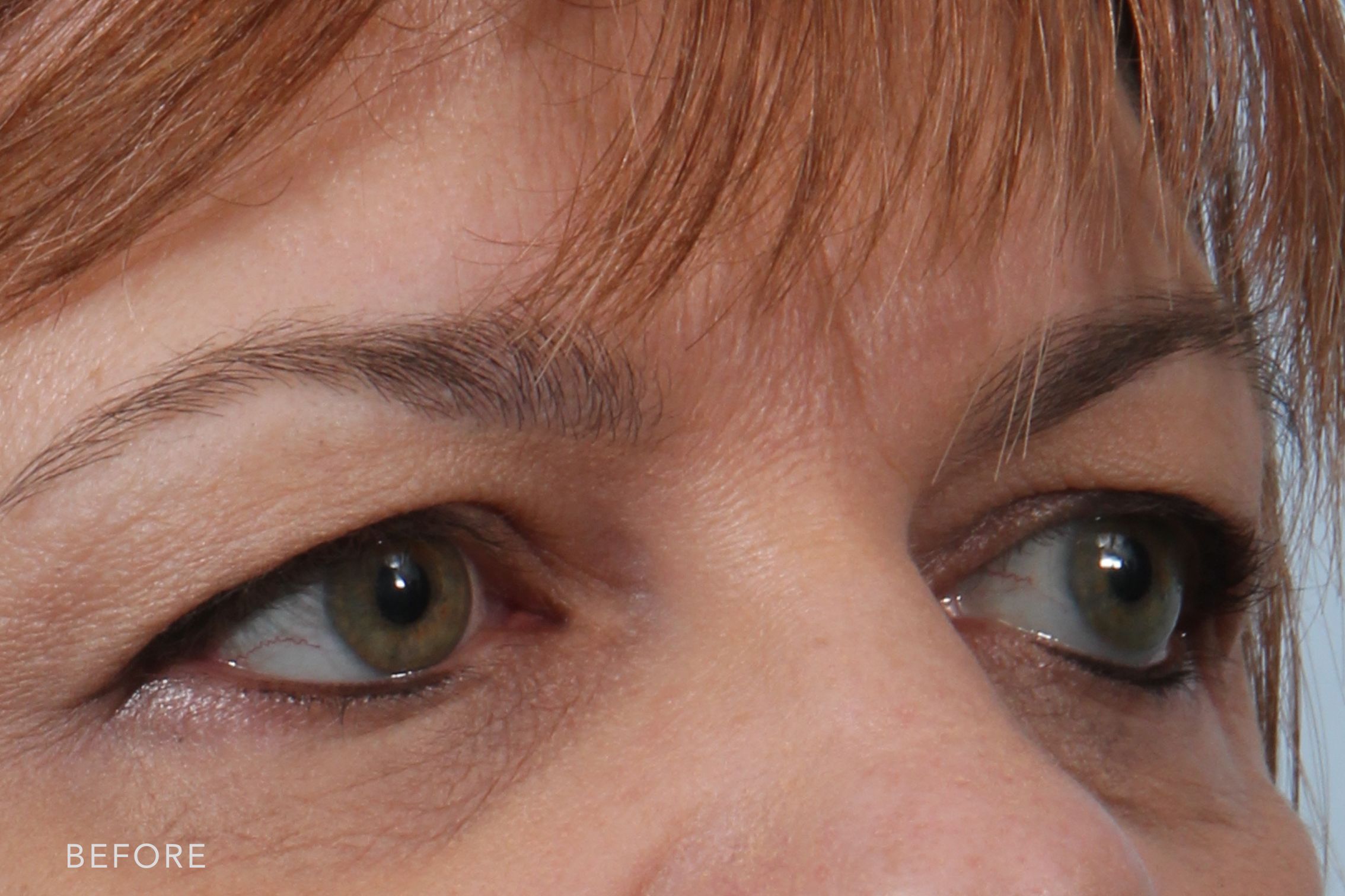 Blepharoplasty Pictures - Eyelid Surgery | Williams Center Williams Center