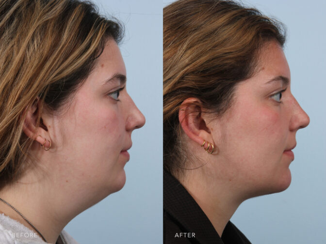 Neck Liposuction Archives - Williams Center Williams Center