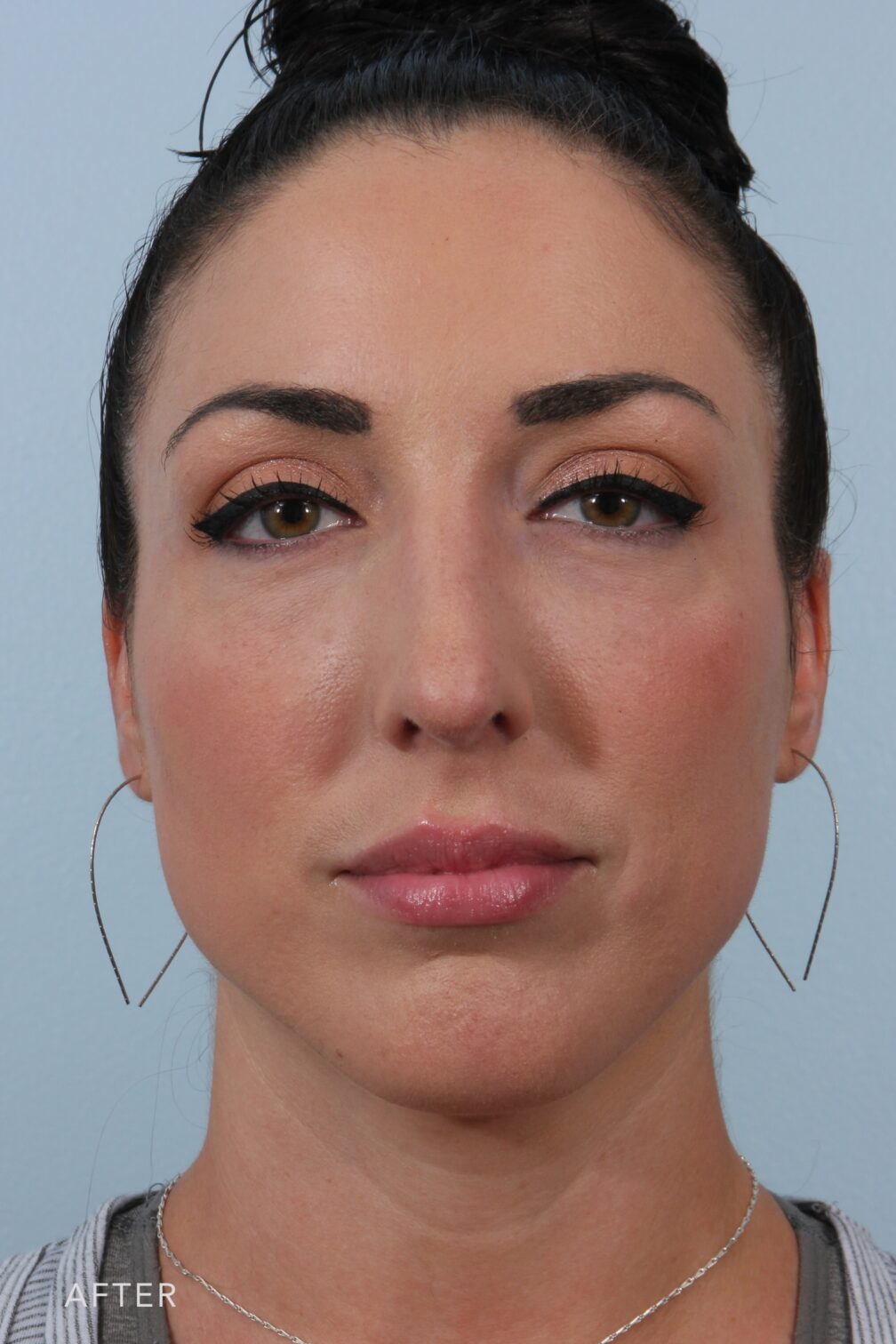 Rhinoplasty & Nasal Reconstruction Pictures | Williams Center Williams ...