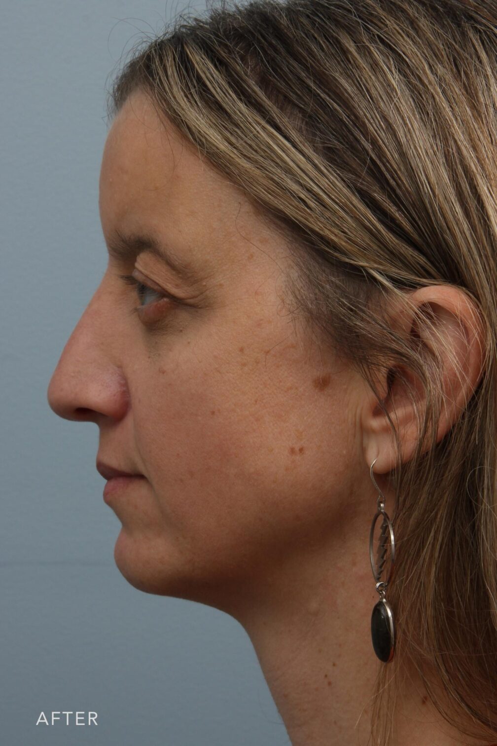 Rhinoplasty & Nasal Reconstruction Pictures | Williams Center Williams ...