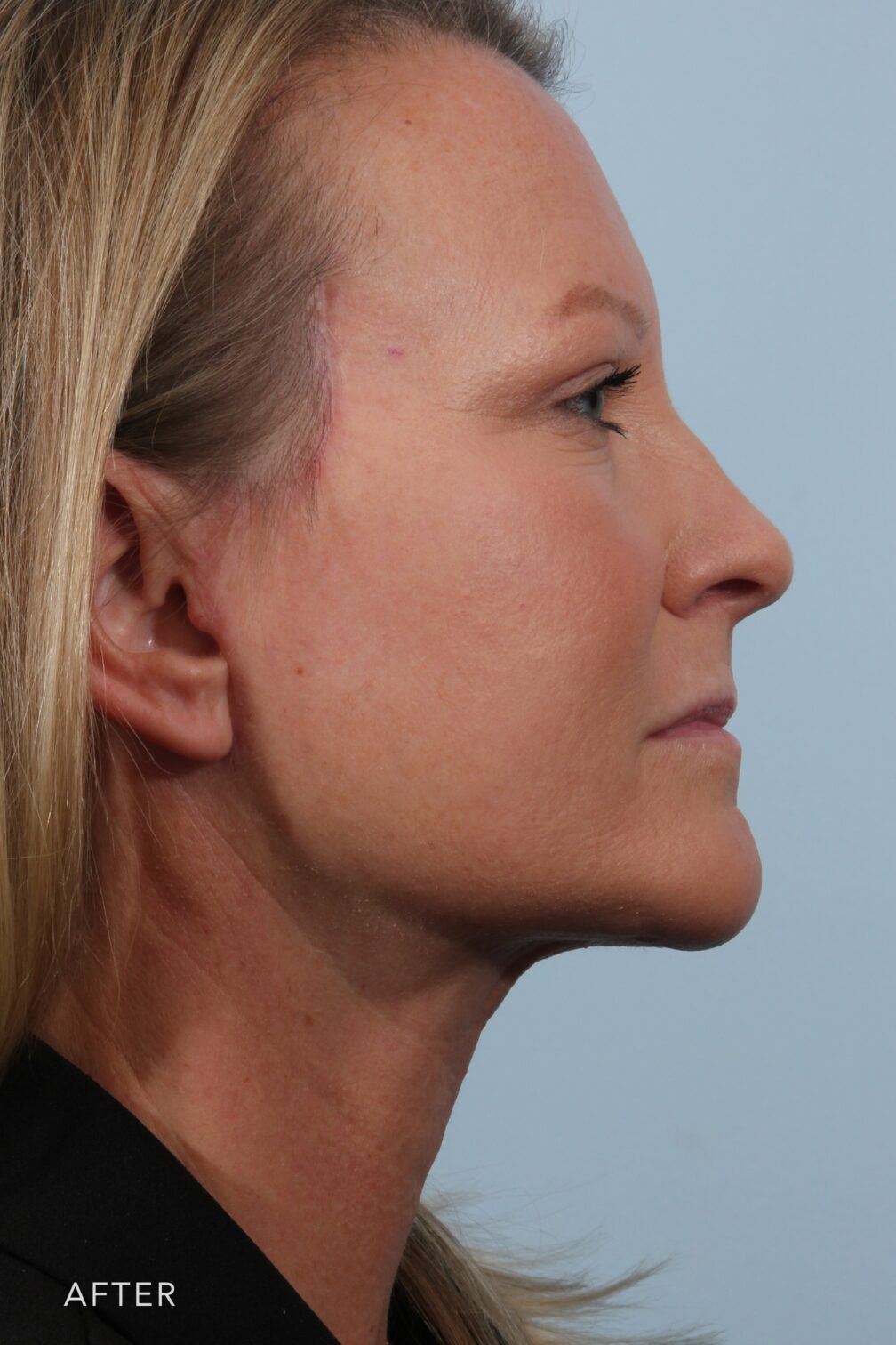 Deep Plane Facelift Before & After Pictures | Williams Center Williams ...