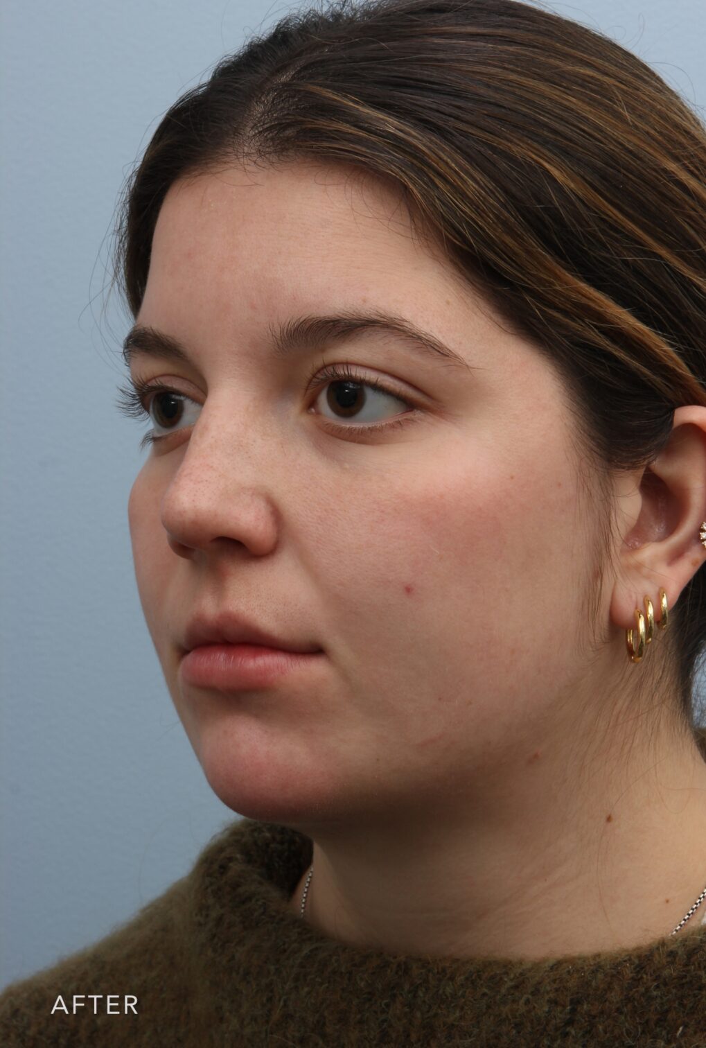 Neck Liposuction Gallery | The Williams Center Williams Center