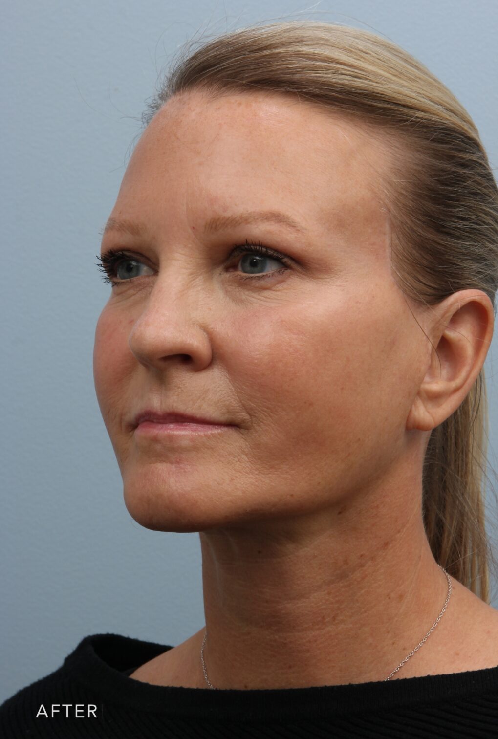 Blepharoplasty Pictures - Eyelid Surgery | Williams Center Williams Center