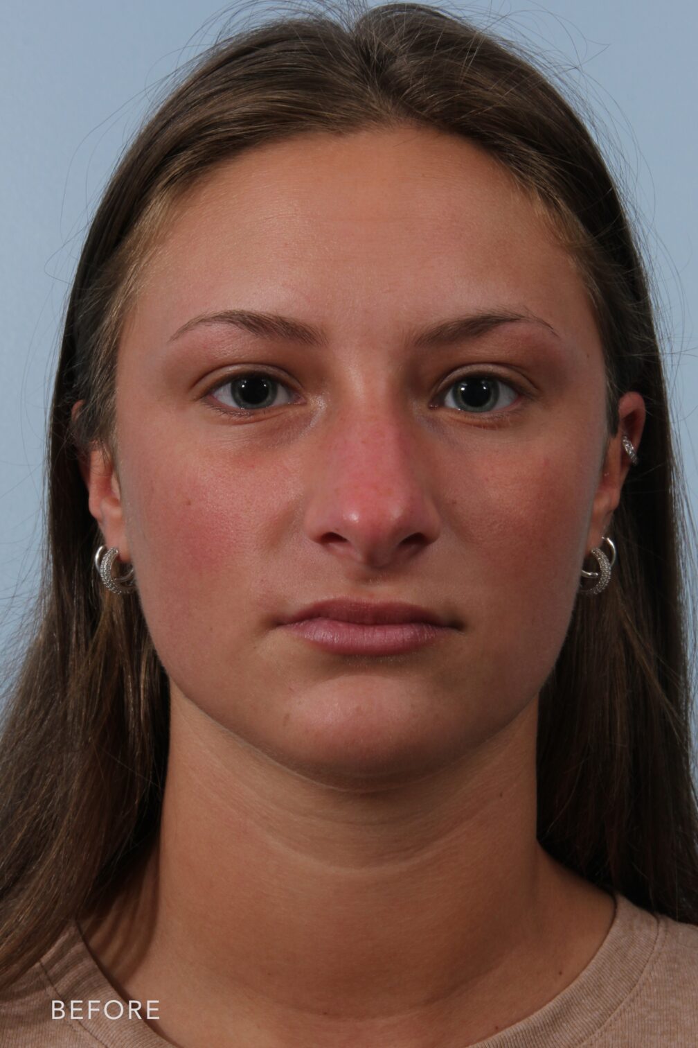 Rhinoplasty & Nasal Reconstruction Gallery | The Williams Center ...