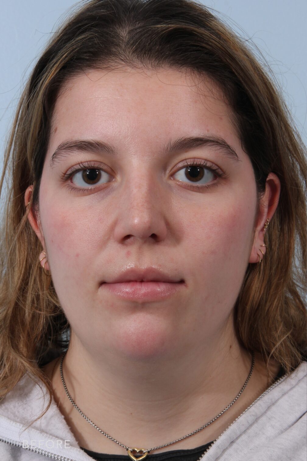 Neck Liposuction Gallery | The Williams Center Williams Center