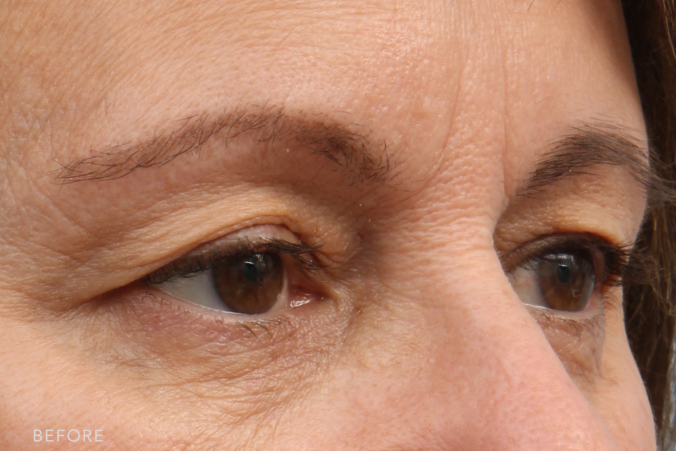 Blepharoplasty Gallery | The Williams Center Williams Center