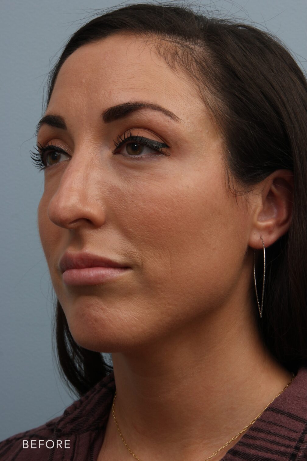 Rhinoplasty & Nasal Reconstruction Pictures | Williams Center Williams ...