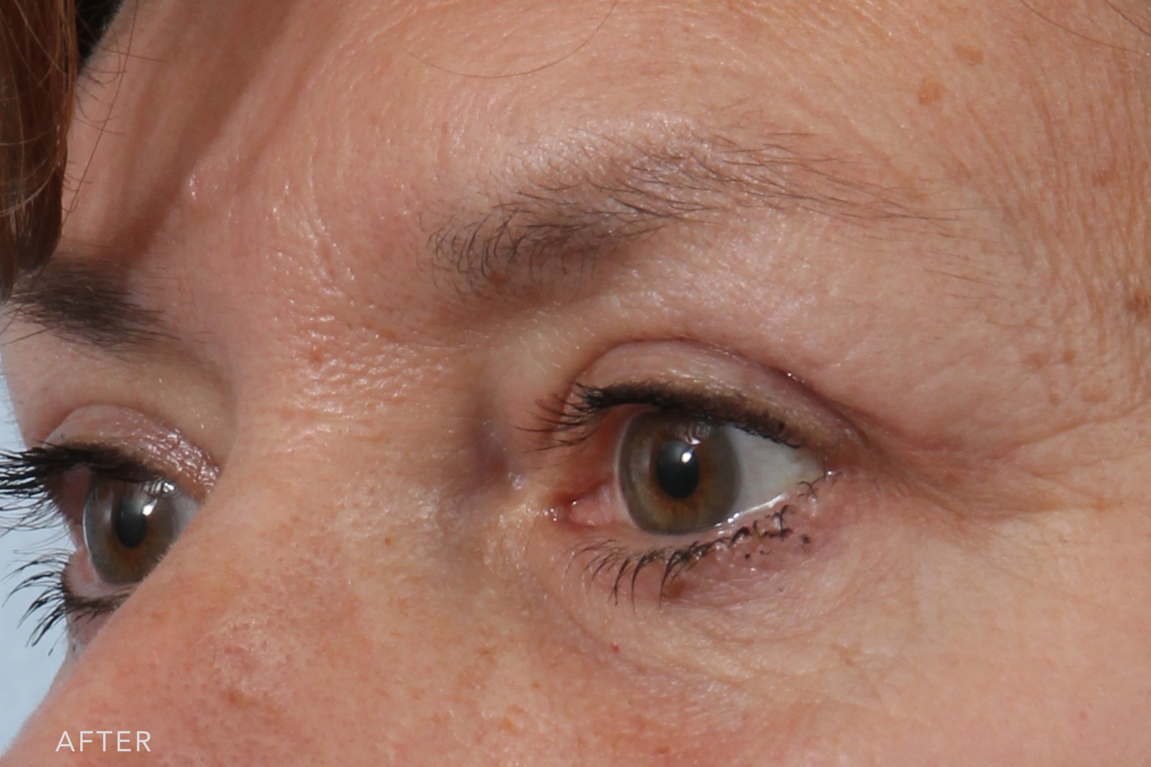 Blepharoplasty Pictures - Eyelid Surgery | Williams Center Williams Center