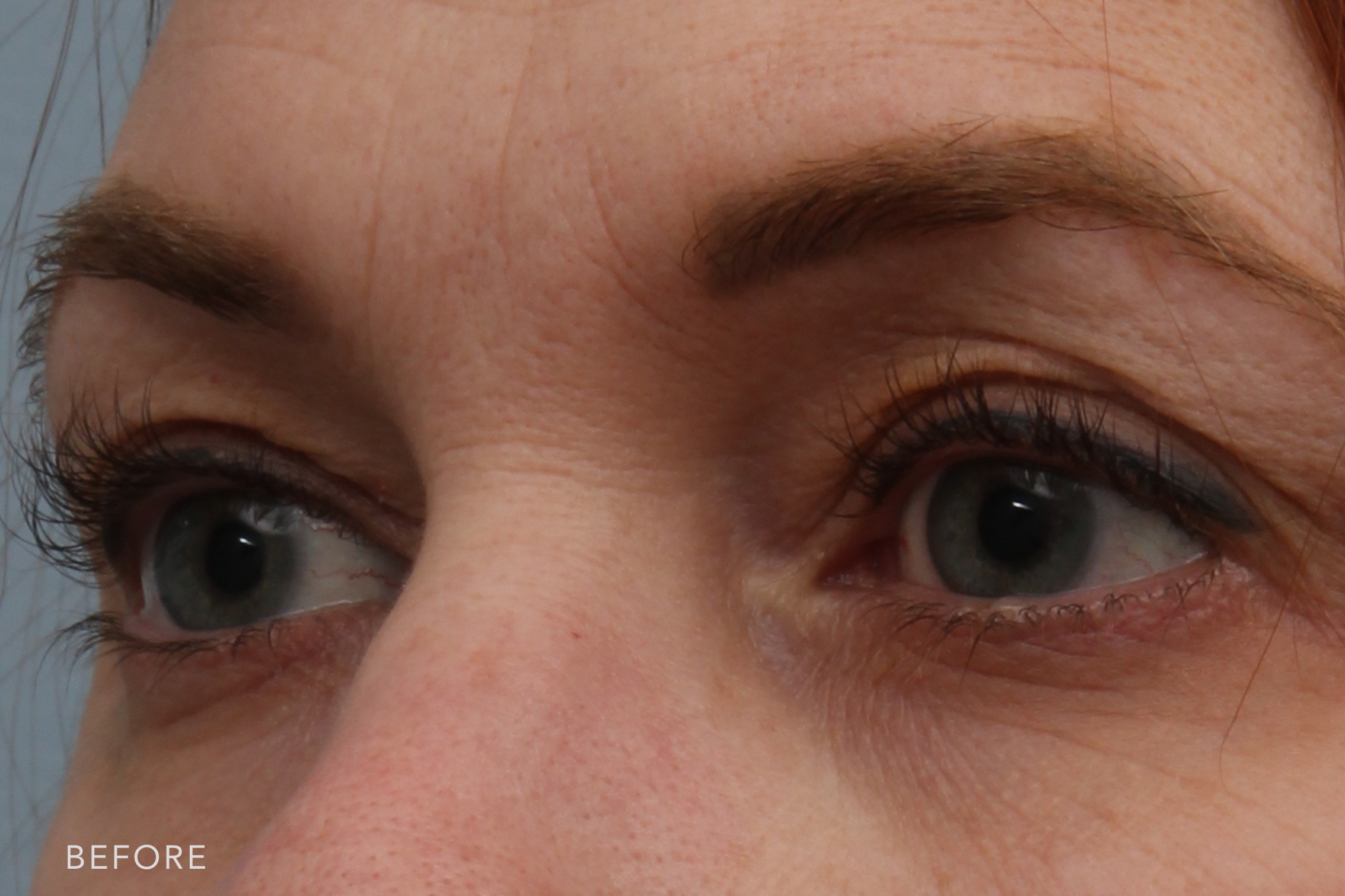 Blepharoplasty Pictures - Eyelid Surgery | Williams Center Williams Center