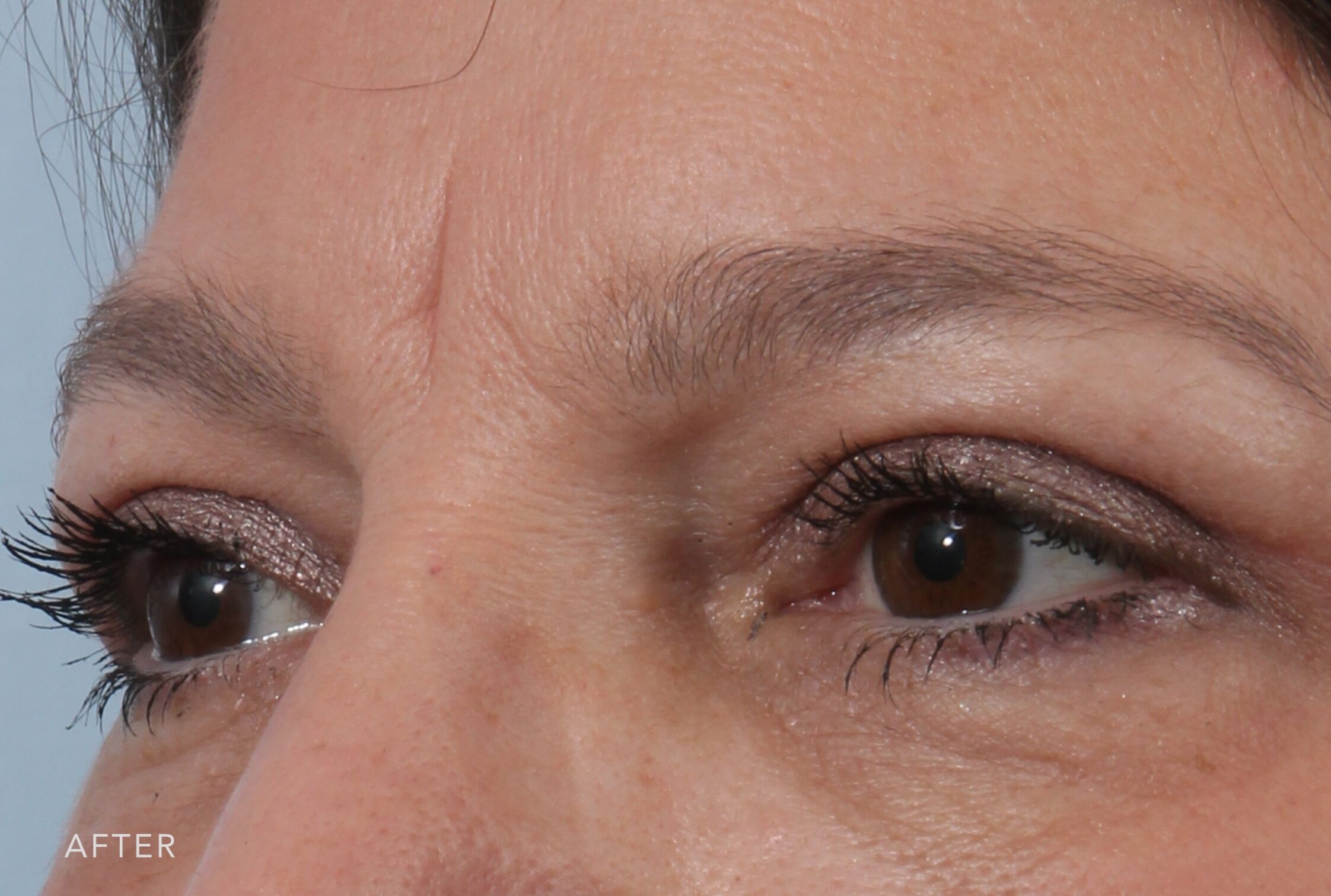 Blepharoplasty Pictures - Eyelid Surgery | Williams Center Williams Center