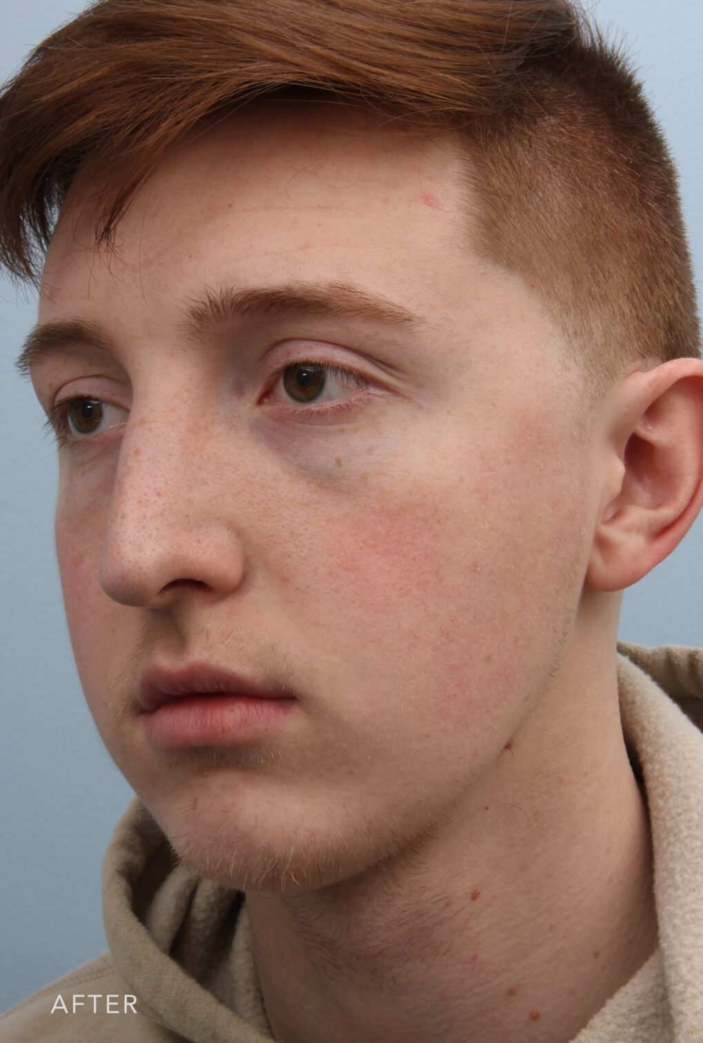 Rhinoplasty & Nasal Reconstruction Pictures | Williams Center Williams ...