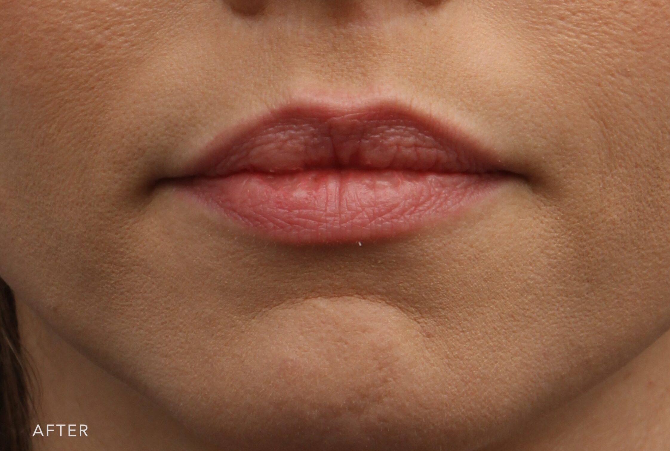 Lip Lift Before & After Gallery - The Williams Center Williams Center
