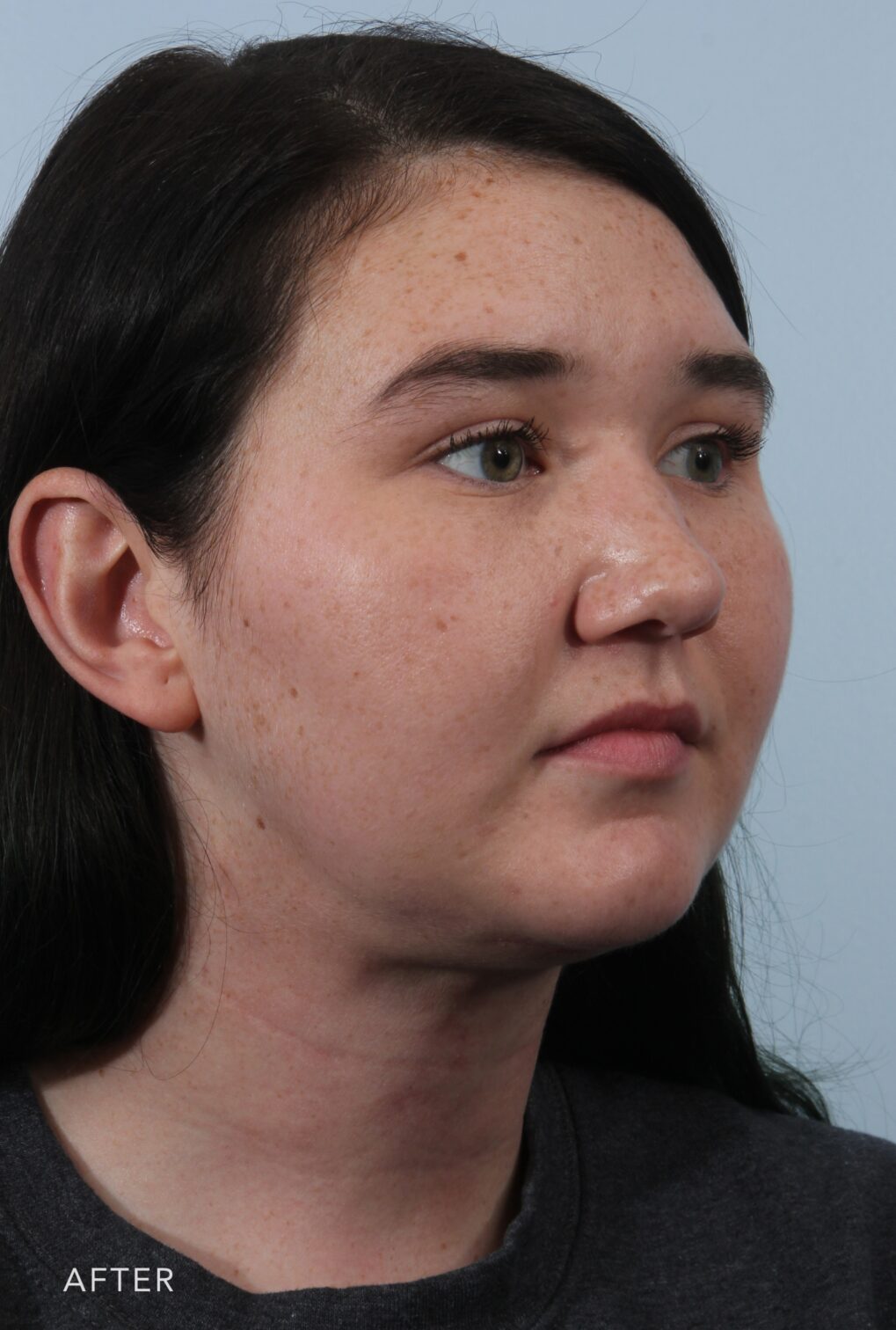 Neck Liposuction Gallery | The Williams Center Williams Center