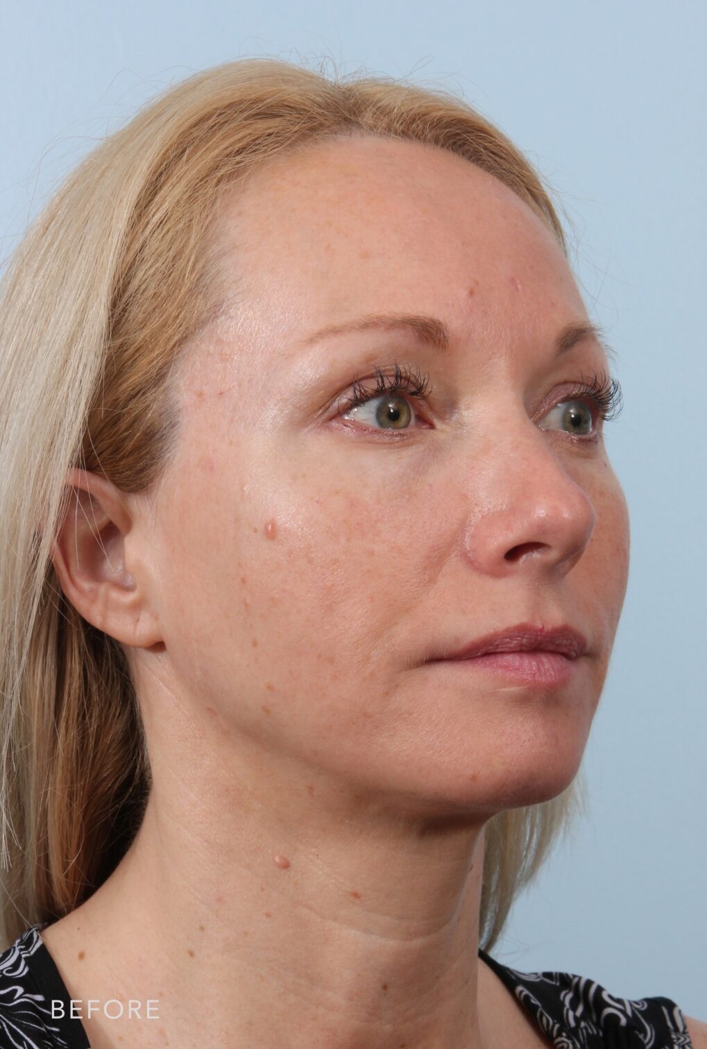 Lip Lift Before & After Gallery - The Williams Center Williams Center