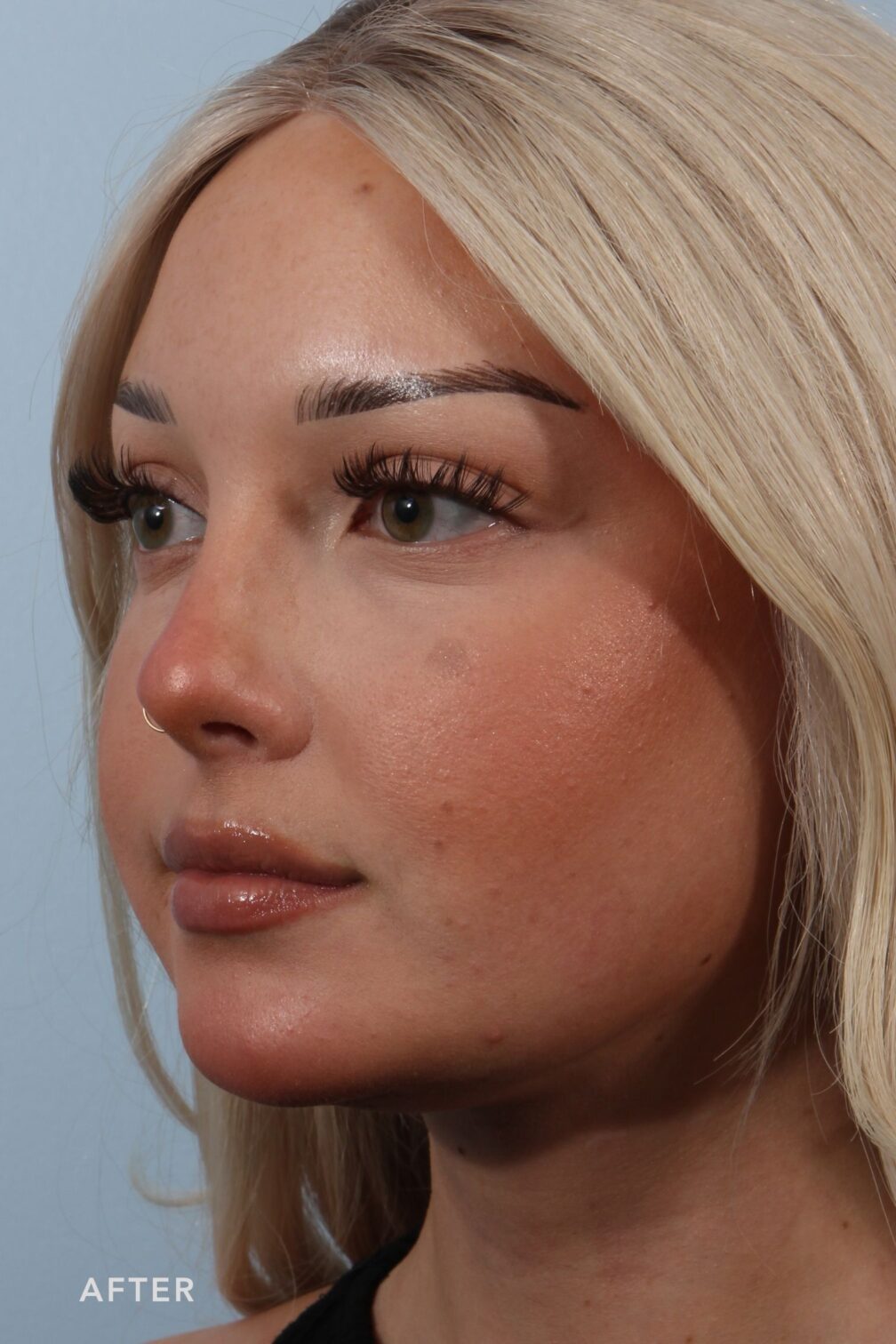 Deep Neck Lift Before and After - The Williams Center Williams Center