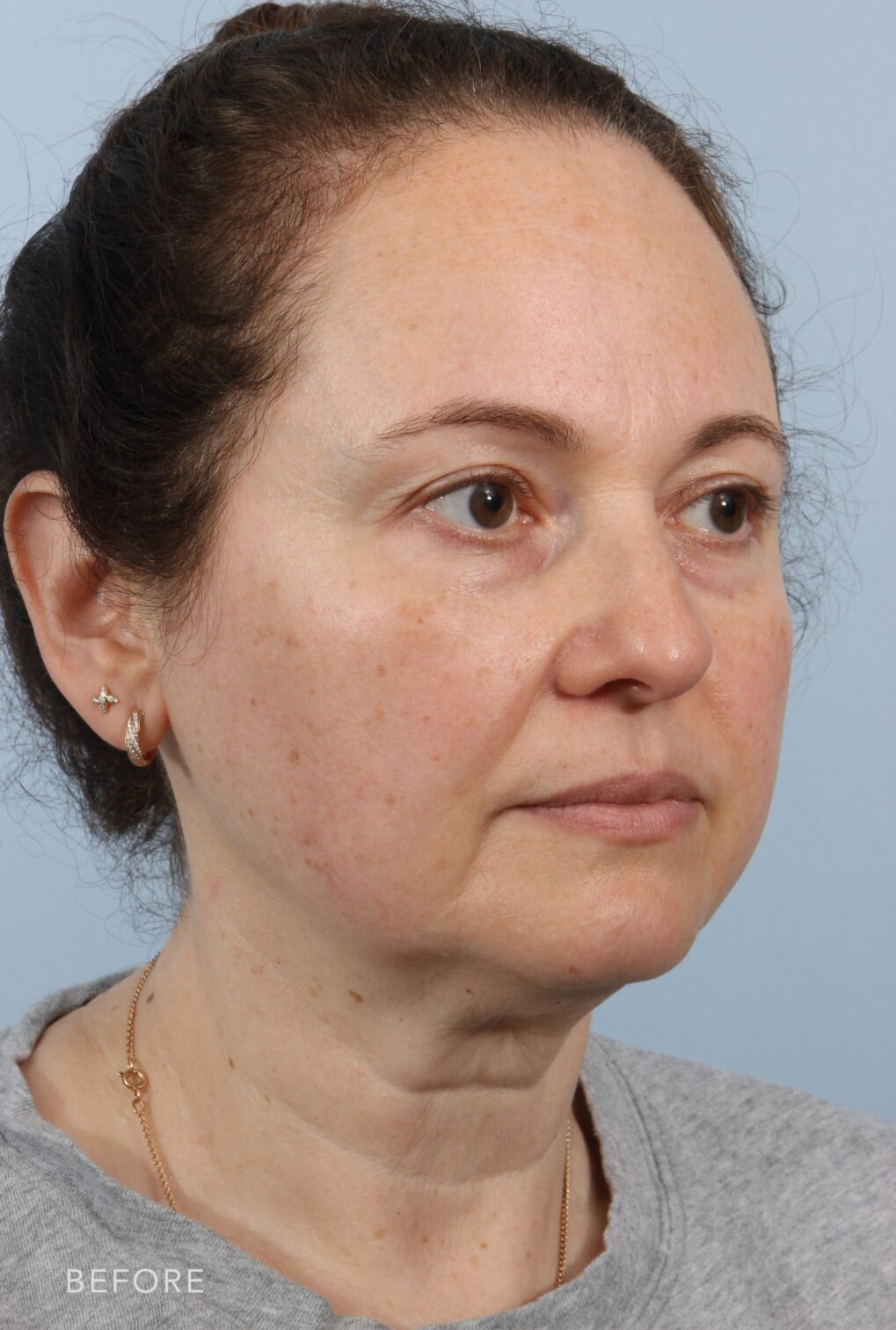 Natural Facelift Before & After - The Williams Center Williams Center